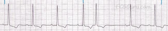 Left ventricular hypertrophy | ECG Guru - Instructor Resources Left ventricular hypertrophy | ECG Guru - Instructor Resources