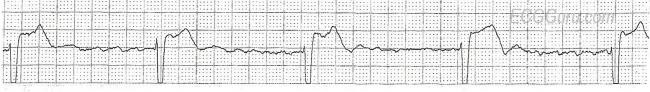 Ecg Basics Atrial Fibrillation With Complete Av Block Ecg Guru Instructor Resources