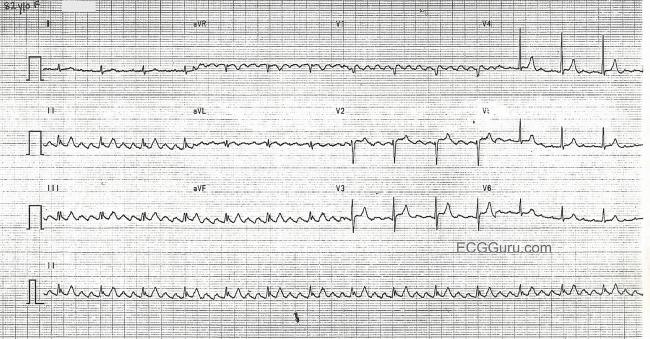 Atrial Flutter | ECG Guru - Instructor Resources Atrial Flutter | ECG Guru - Instructor Resources