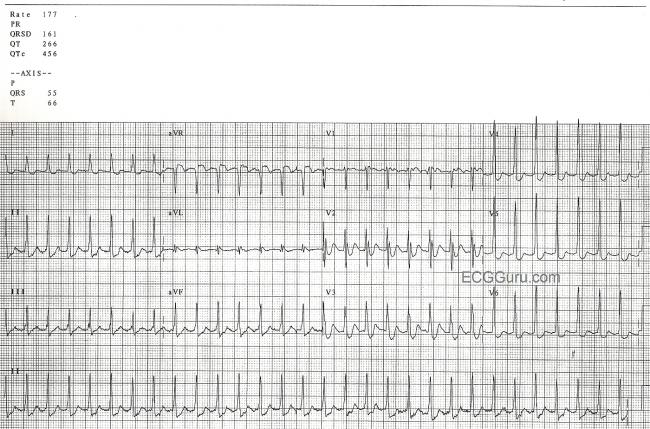 Paroxysmal Supraventricular Tachycardia | ECG Guru - Instructor Resources Paroxysmal Supraventricular Tachycardia | ECG Guru - Instructor Resources