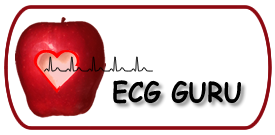 Ventricular tachycardia | Page 3 | ECG Guru - Instructor Resources