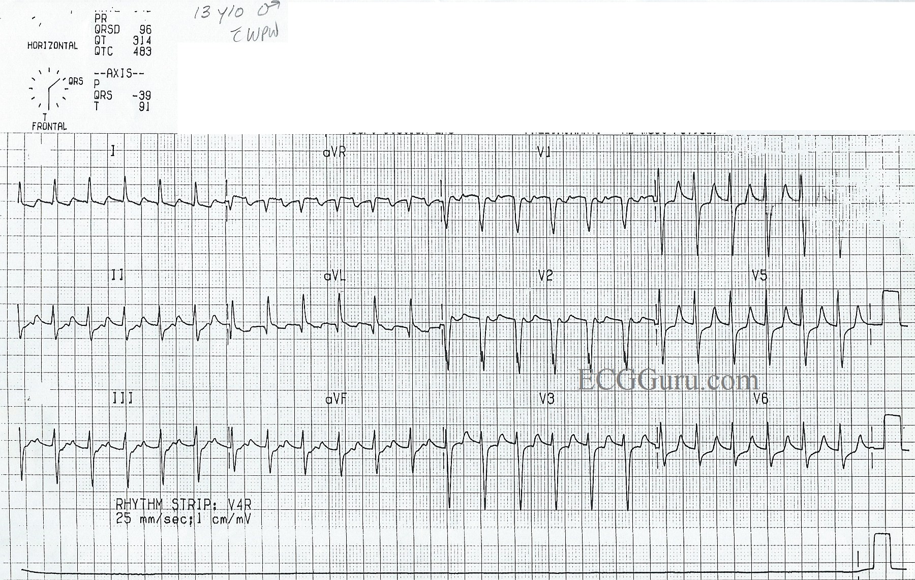 Supraventricular tachycardia | ECG Guru - Instructor Resources