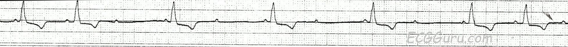 ECG Basics: Second-degree AV Block With Characteristics of Type I and ...