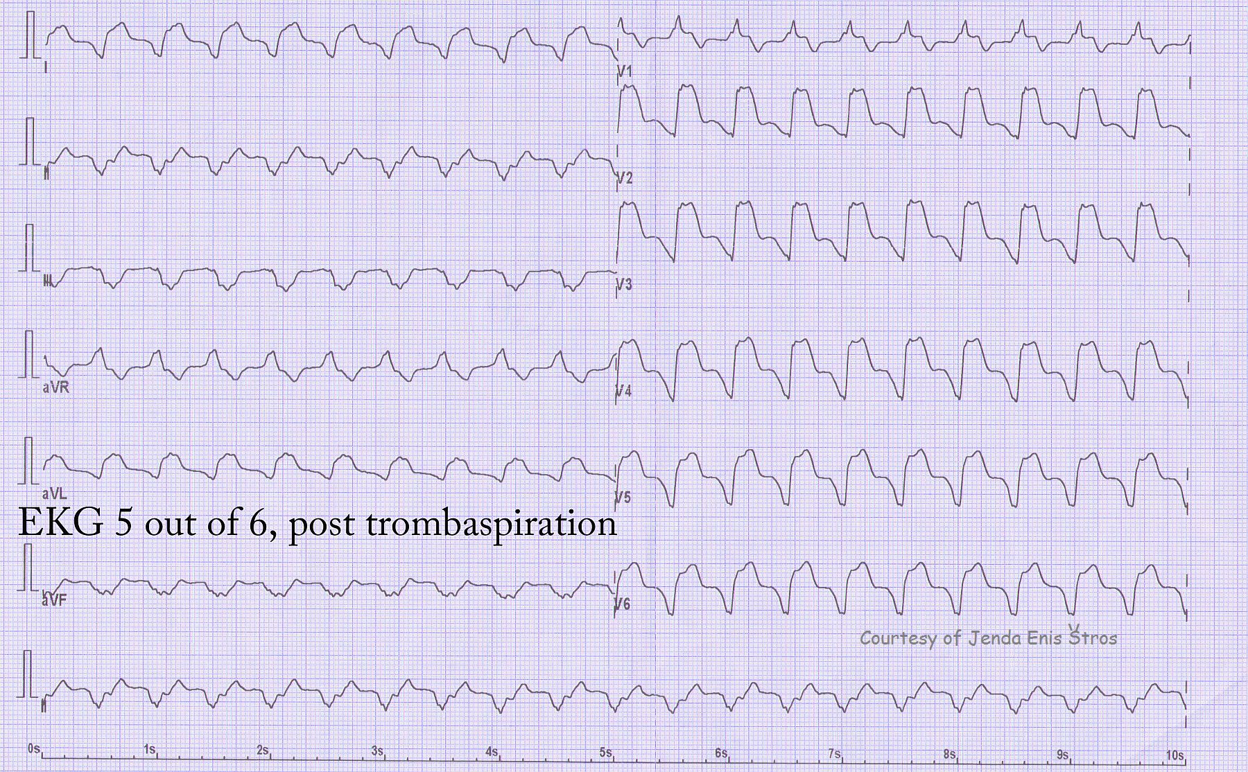 Teaching Series 1113: ECG 5 of 6 - Acute Anterior Wall M.I. | ECG Guru ...