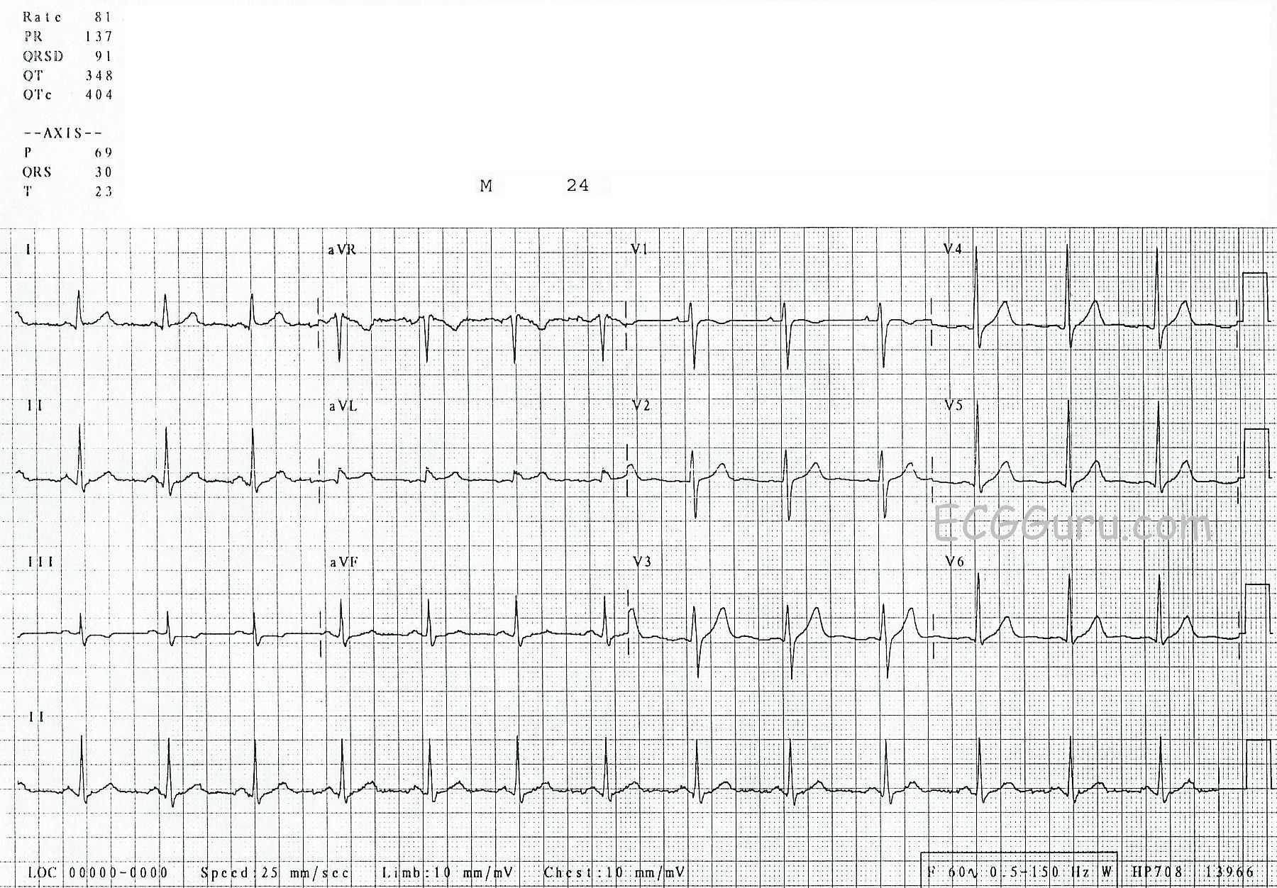 Electrocardiograma Normal Electrocardiograma Normal