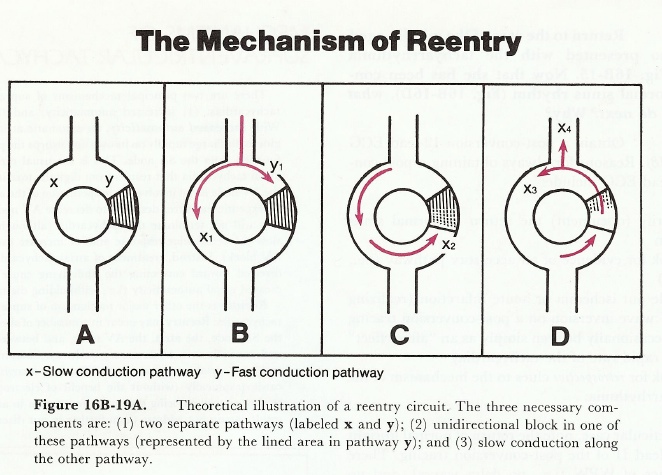 Reentry Supraventricular Tachycardia Acls Identification Of