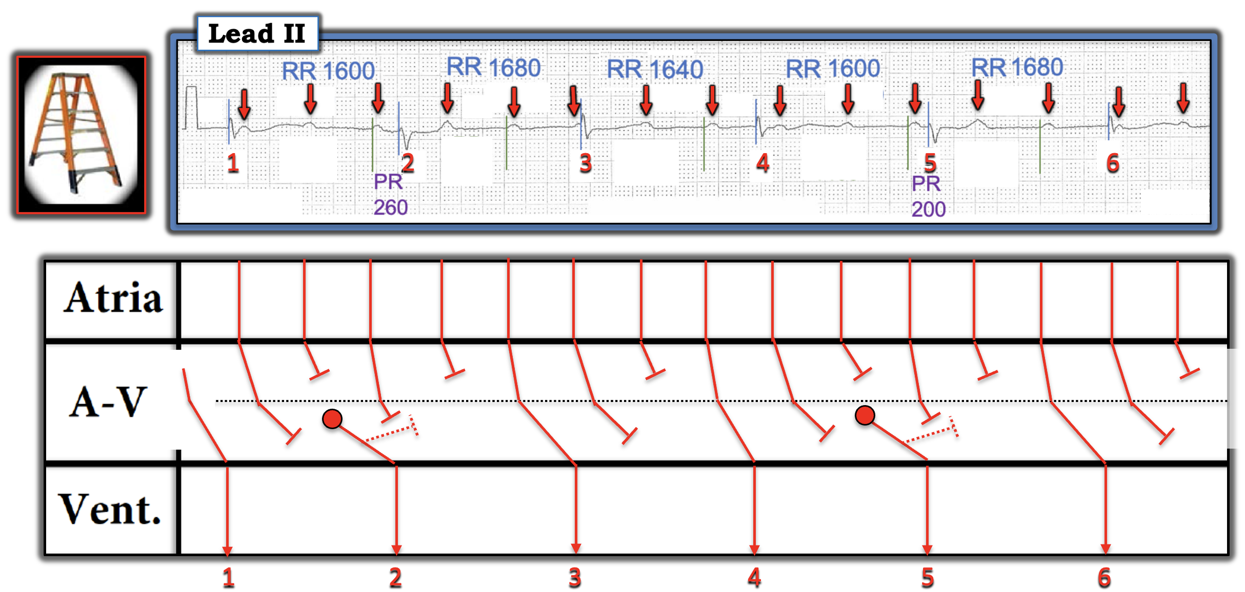 Complete Heart Block or High Grade AVB? | ECG Guru - Instructor Resources
