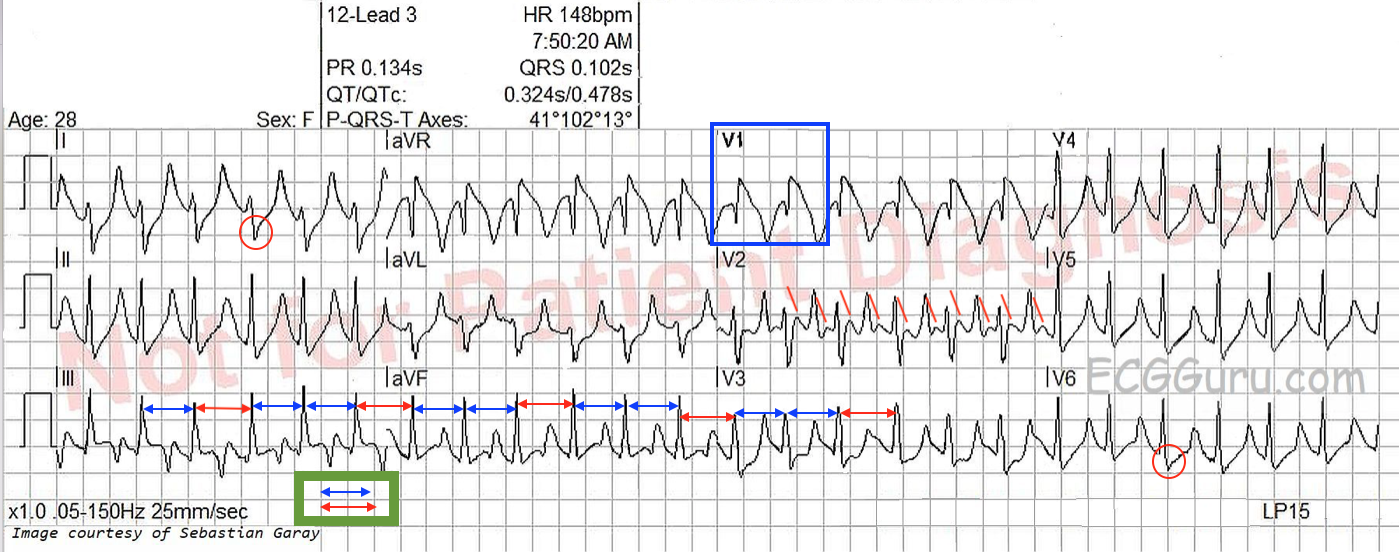 Tachycardia In An Unresponsive Patient | ECG Guru - Instructor Resources