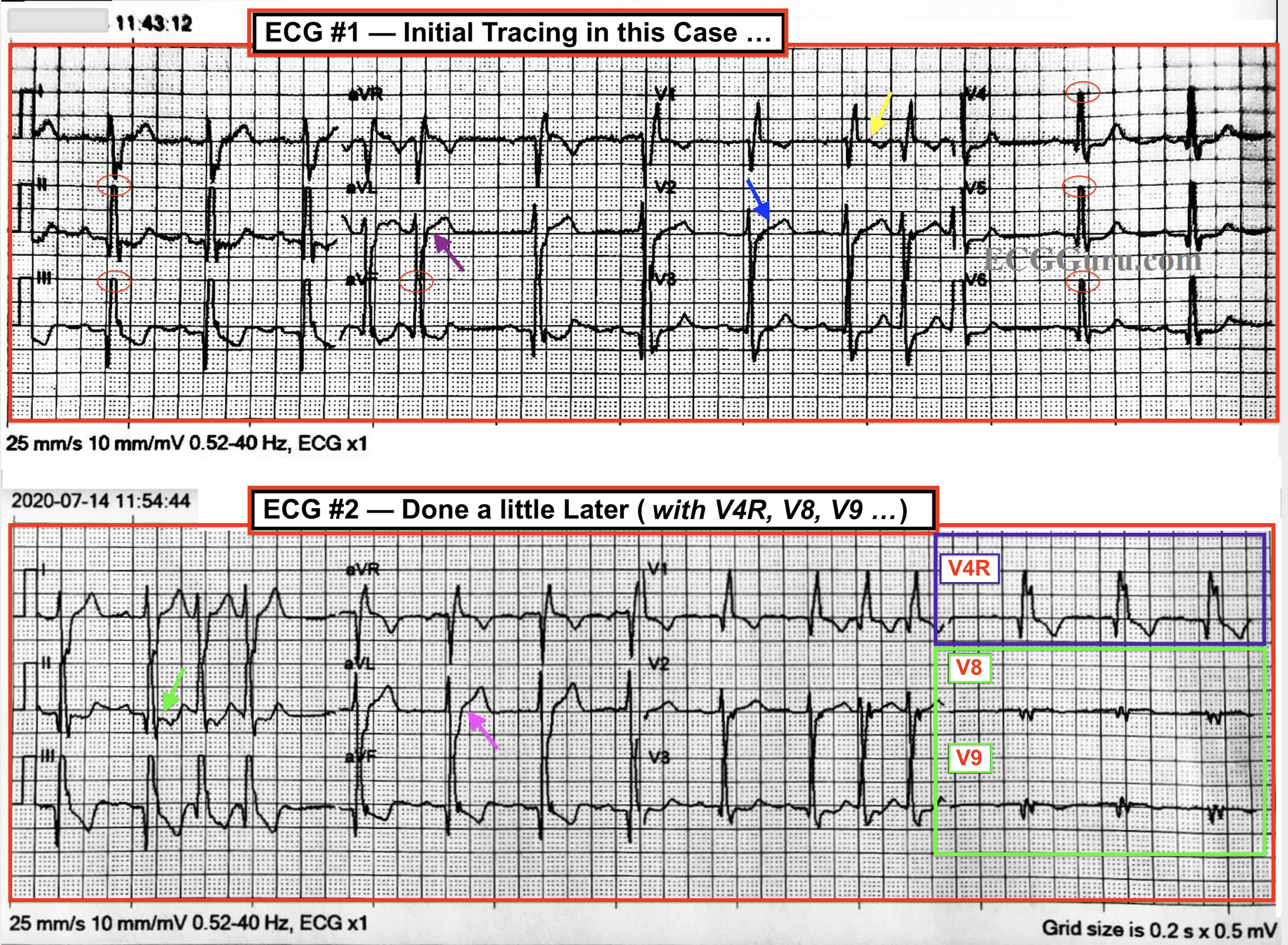 Right Bundle Branch Block and More | ECG Guru - Instructor Resources