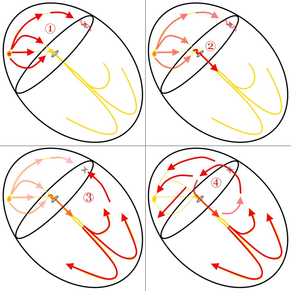 Orthodromic Conduction in SVT | ECG Guru - Instructor Resources