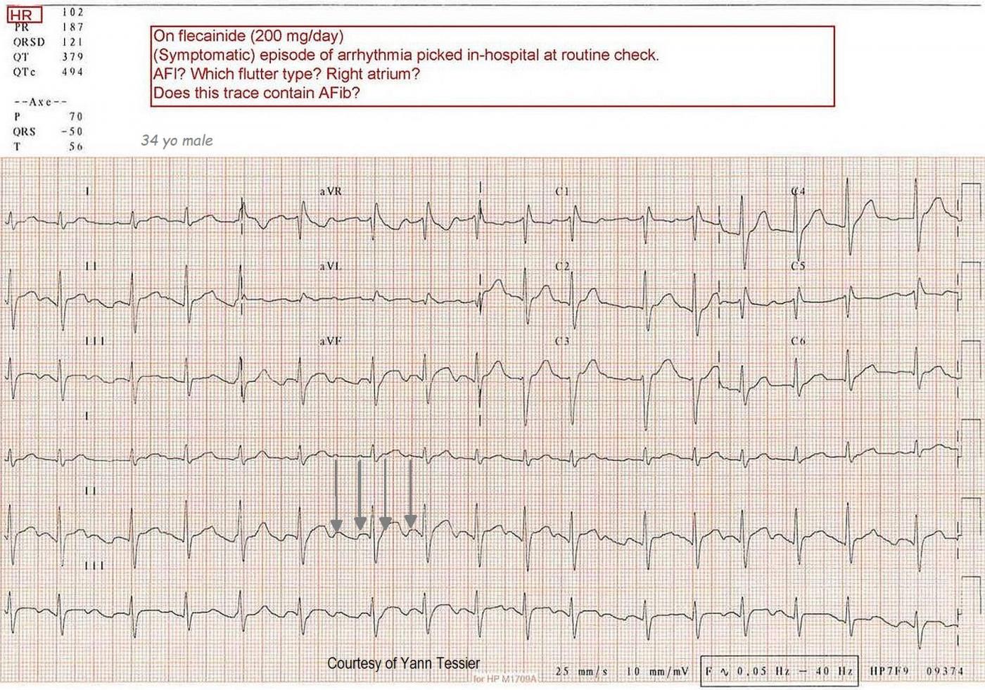 ECG Teaching Series: Atrial Flutter | ECG Guru - Instructor Resources