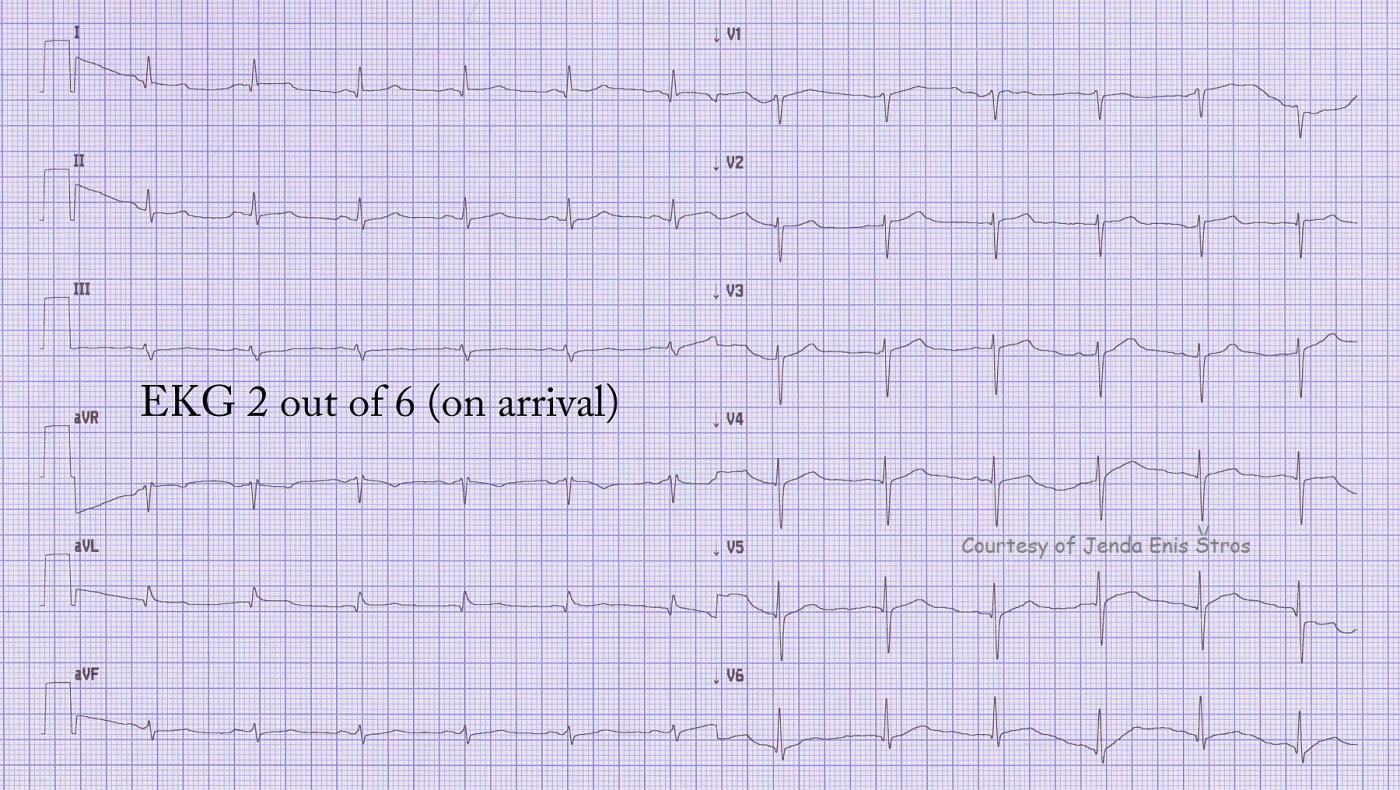 Teaching Series 1113: ECG 2 of 6 - Acute Anterior Wall M.I. | ECG Guru ...