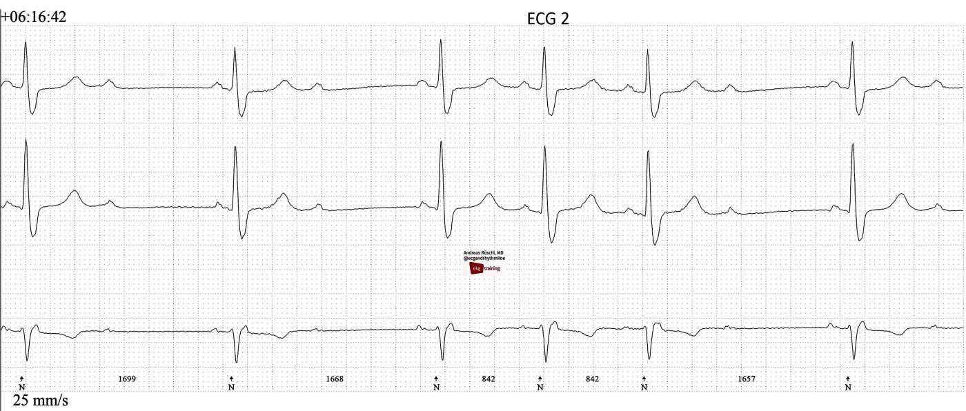 Second-degree AV Block, Mobitz Type II | ECG Guru - Instructor Resources Second-degree AV Block, Mobitz Type II | ECG Guru - Instructor Resources