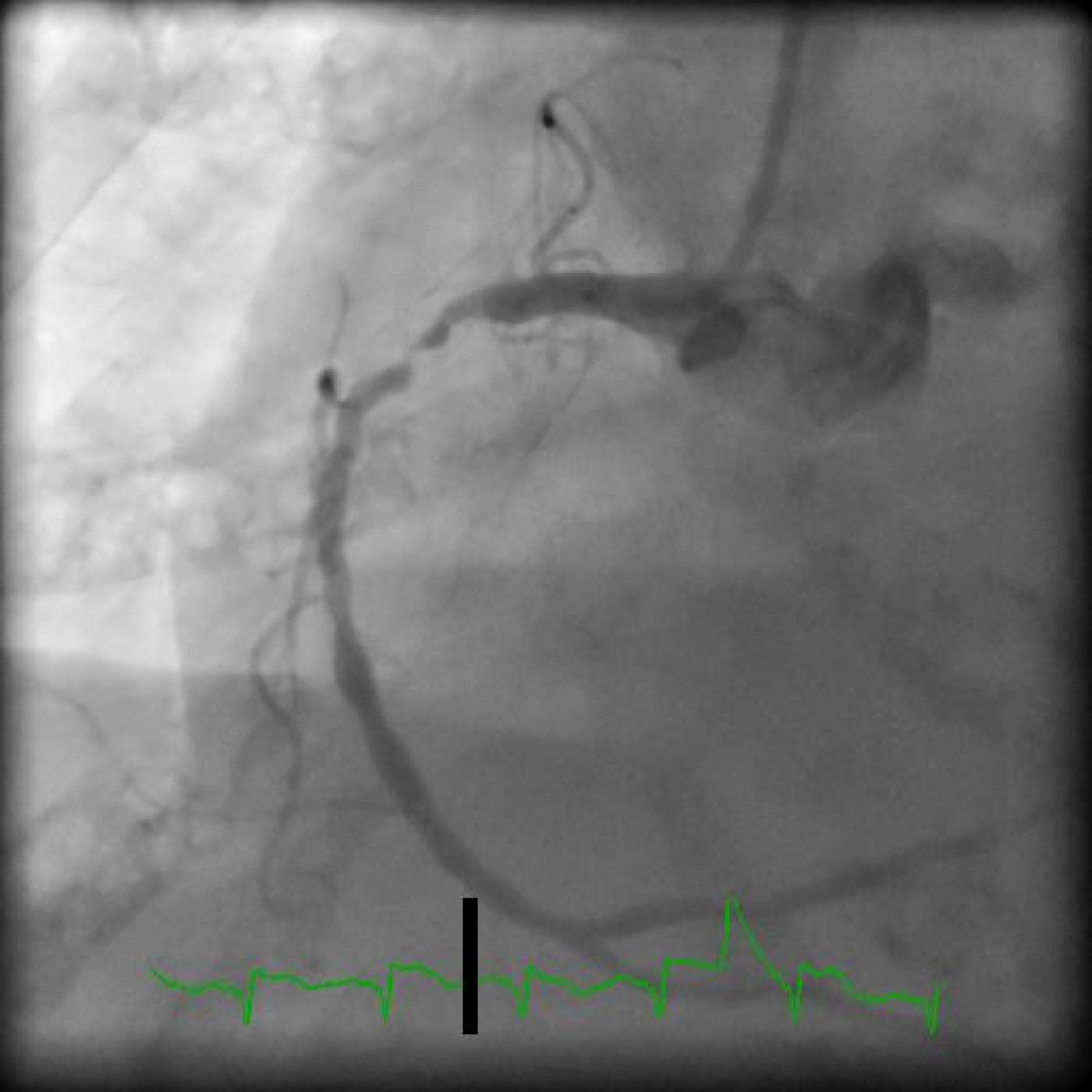 Extensive Anterior Wall M.I. With Recent Inferior Wall M.I. | ECG Guru ...