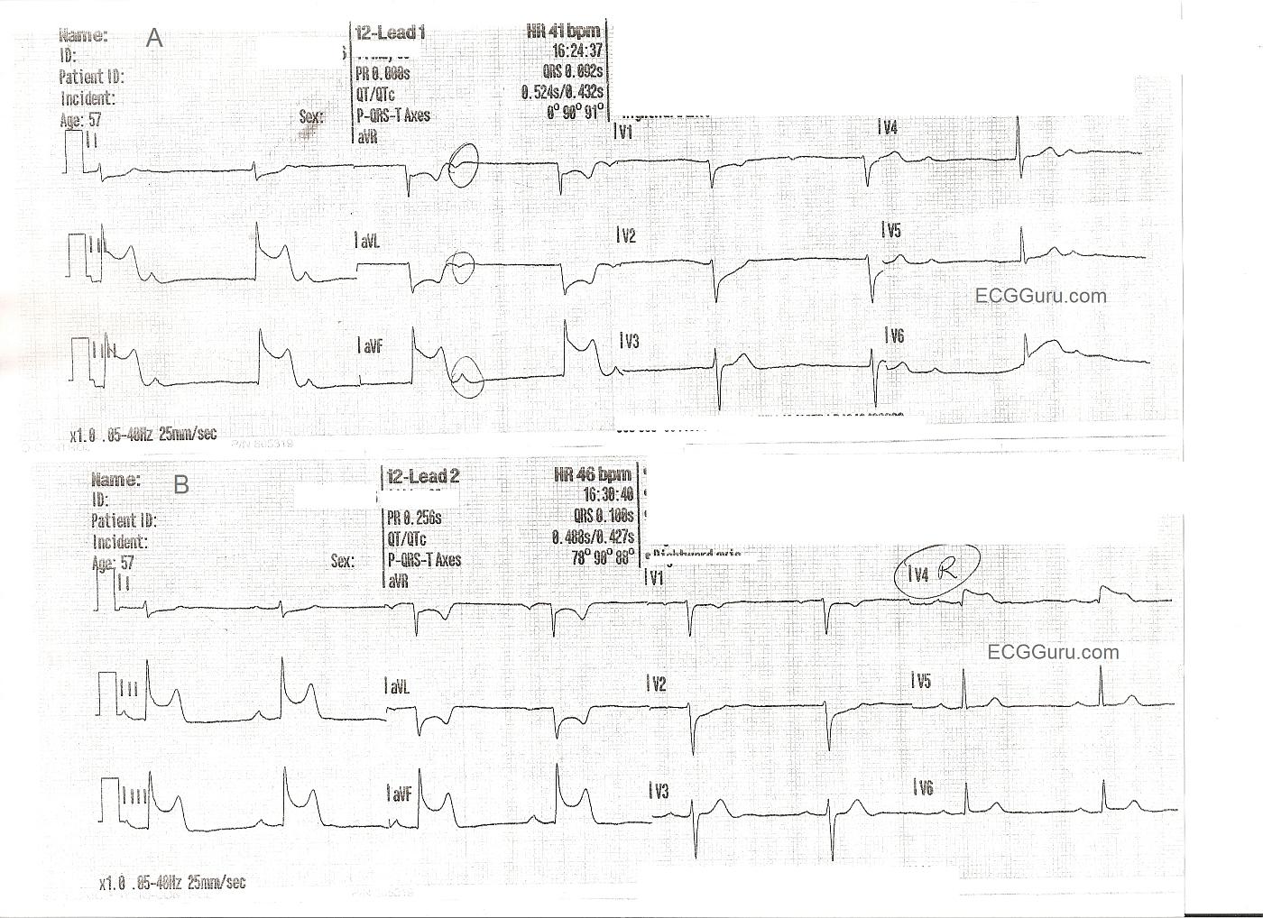 Inferior Wall M.I. with Right Ventricular M.I. | ECG Guru - Instructor ... Inferior Wall M.I. with Right Ventricular M.I. | ECG Guru - Instructor ...