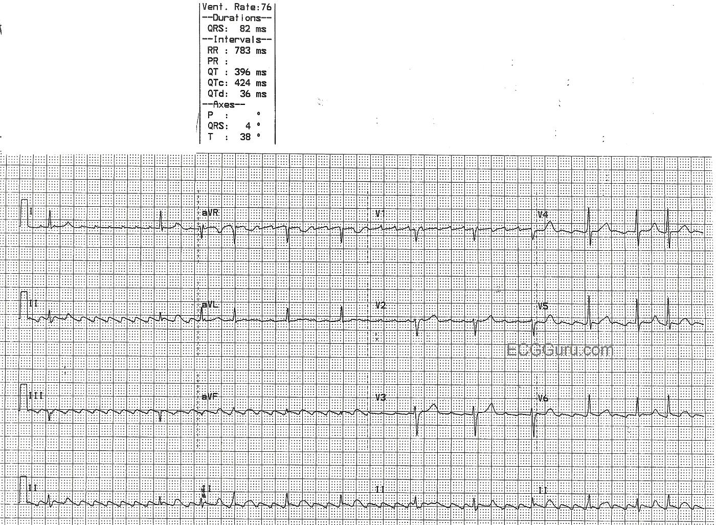 Atrial Flutter With Variable Conduction Ecg Guru Instructor Resources
