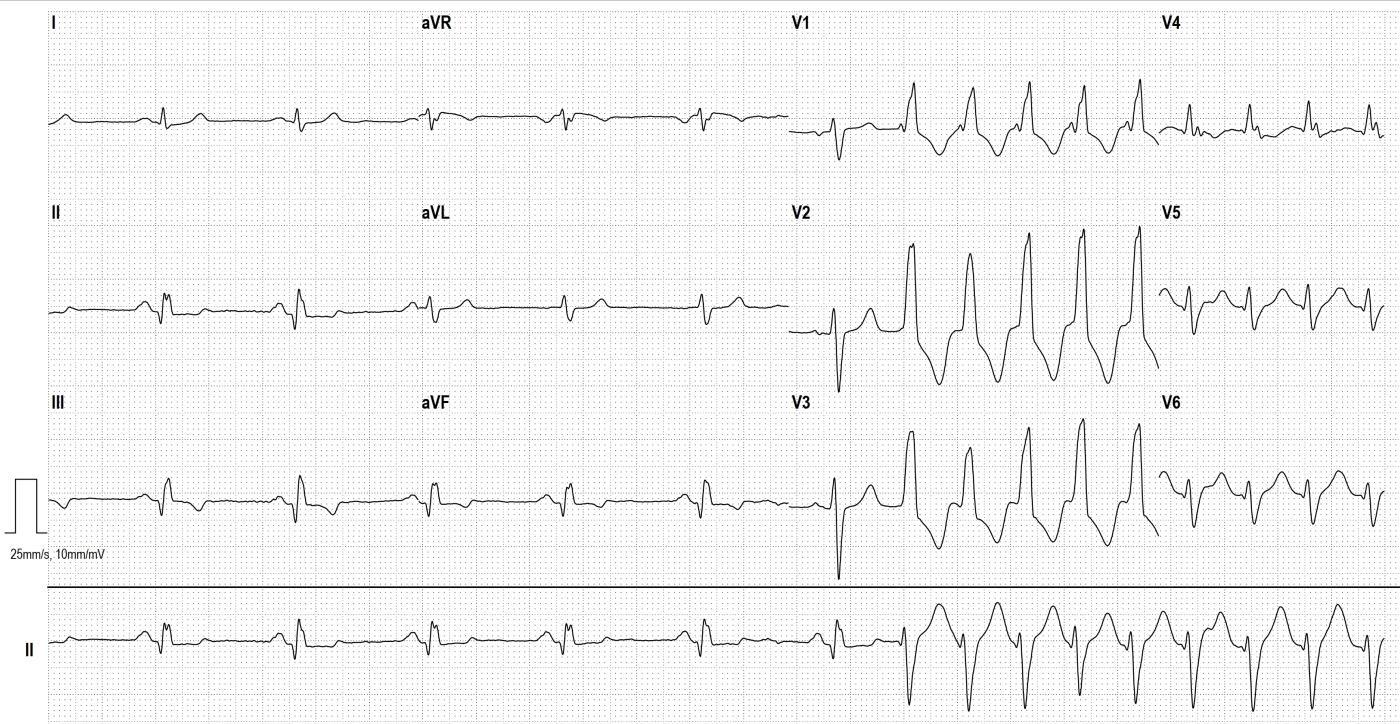 Ventricular Tachycardia Ecg Guru Instructor Resources