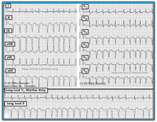 Atrial fibrillation and Type 2 M.I. | ECG Guru - Instructor Resources