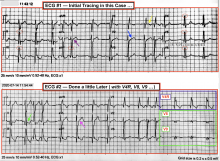 Right Bundle Branch Block and More | ECG Guru - Instructor Resources