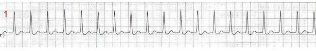 ECG Challenge: Grouped Beating - Double Tachycardia - ANSWER | ECG Guru ...