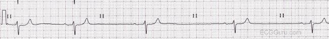 ECG BASICS: Sinus Bradycardia With First-degree AV Block | ECG Guru ...