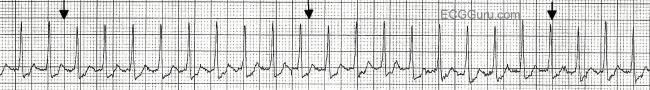 Paroxysmal supraventricular tachycardia | ECG Guru - Instructor Resources