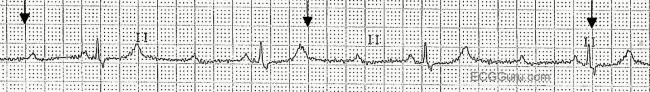 ECG BASICS: Second-degree AV Block, Type II | ECG Guru - Instructor ...