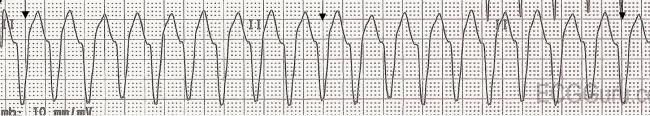 V Tach | ECG Guru - Instructor Resources