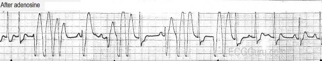 Adenosine | ECG Guru - Instructor Resources