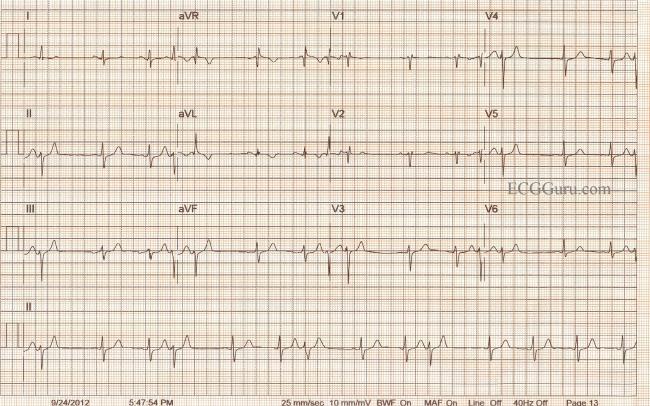 Aberrant conduction | ECG Guru - Instructor Resources