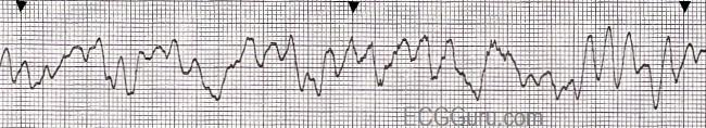 Ventricular fibrillation | ECG Guru - Instructor Resources