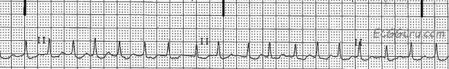 ECG Basics: Atrial Fibrillation With Rapid Ventricular Response | ECG ...