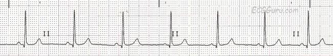 ECG Basics: Normal Sinus Rhythm | ECG Guru - Instructor Resources