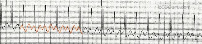 ECG Basics: Atrial Flutter With 2:1 Conduction Ratio, Rhythm strip ...