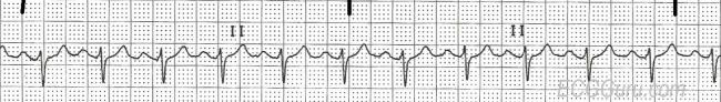 Sinus tachycardia | ECG Guru - Instructor Resources