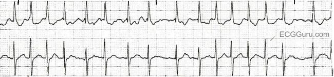 ECG Basics: Atrial Fibrillation With a Rapid Ventricular Response | ECG ...