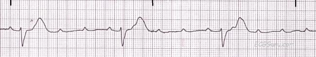 AV block Idioventricular escape rhythm | ECG Guru - Instructor Resources