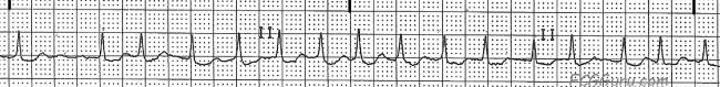 Atrial fibrillation | ECG Guru - Instructor Resources