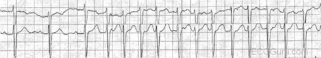 A Fib | ECG Guru - Instructor Resources