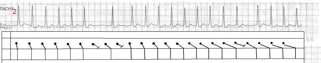 ECG Challenge: Grouped Beating - Double Tachycardia - ANSWER | ECG Guru ...