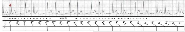 ECG Challenge: Grouped Beating - Double Tachycardia - ANSWER | ECG Guru ...