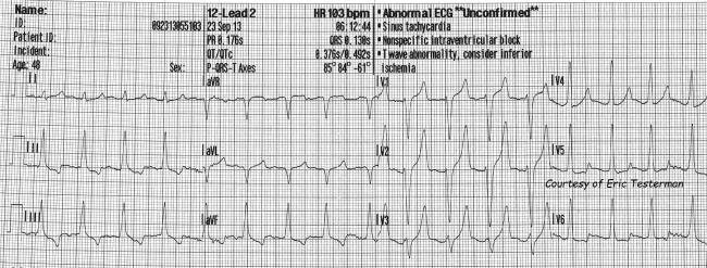Hyperkalemia | ECG Guru - Instructor Resources