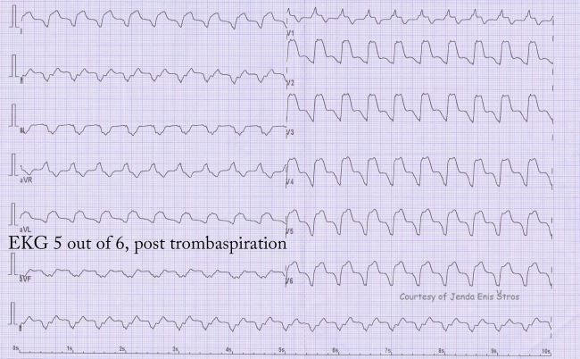 Ventricular tachycardia | ECG Guru - Instructor Resources