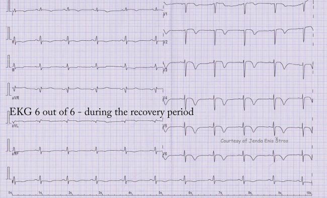 Reperfusion | ECG Guru - Instructor Resources