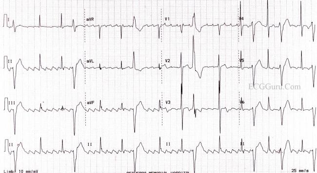 Atrial Flutter With Pvcs Ecg Guru Instructor Resources