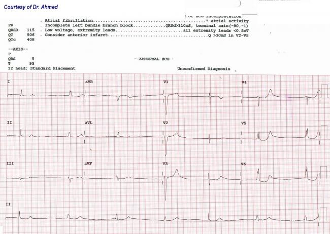 A Fib | ECG Guru - Instructor Resources