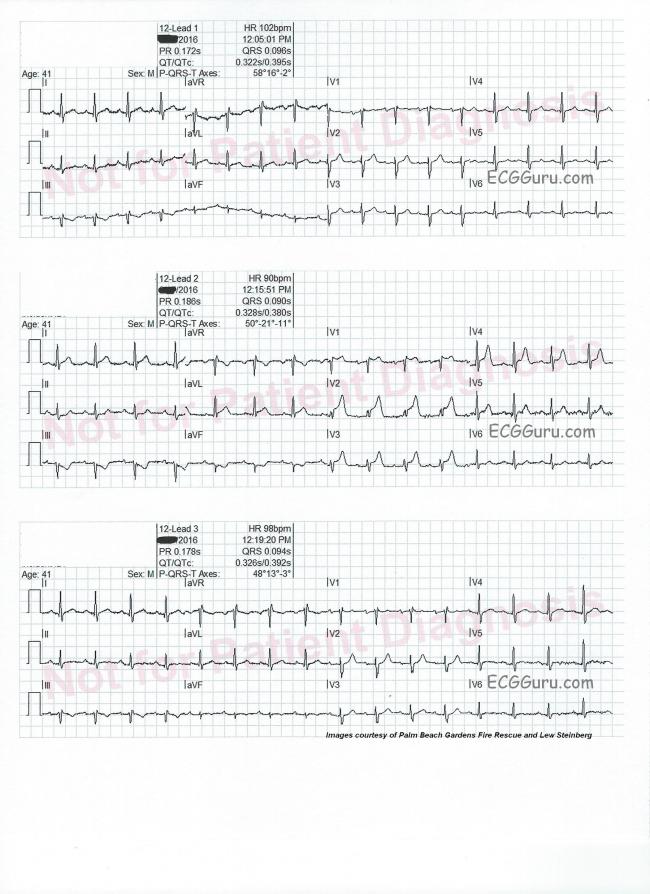Teaching Series: Acute Anterior Wall M.I. | ECG Guru - Instructor Resources