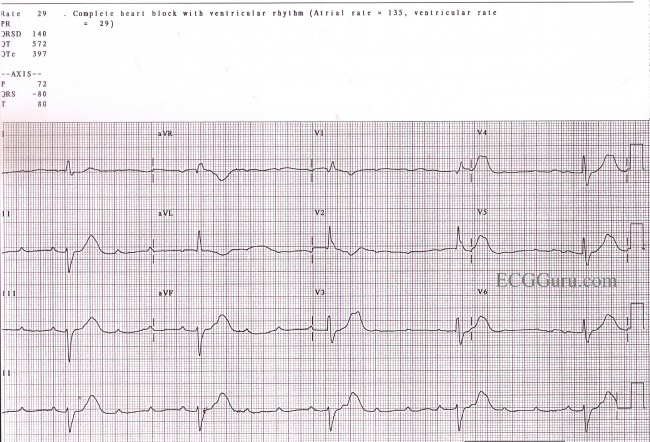 High-grade AV Block | ECG Guru - Instructor Resources