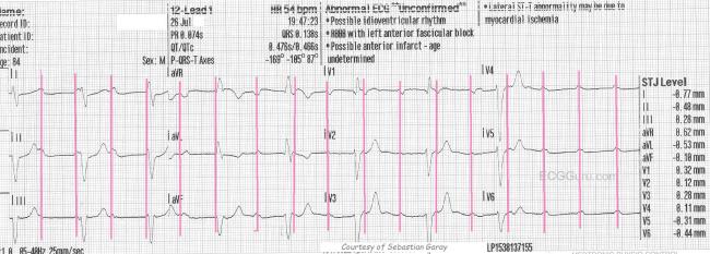 Idioventricular escape rhythm | ECG Guru - Instructor Resources