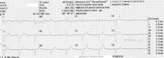 Idioventricular escape rhythm | ECG Guru - Instructor Resources